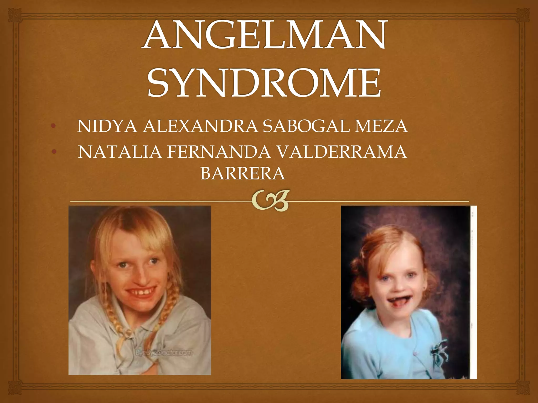 Angelman Syndrome. | PPTX