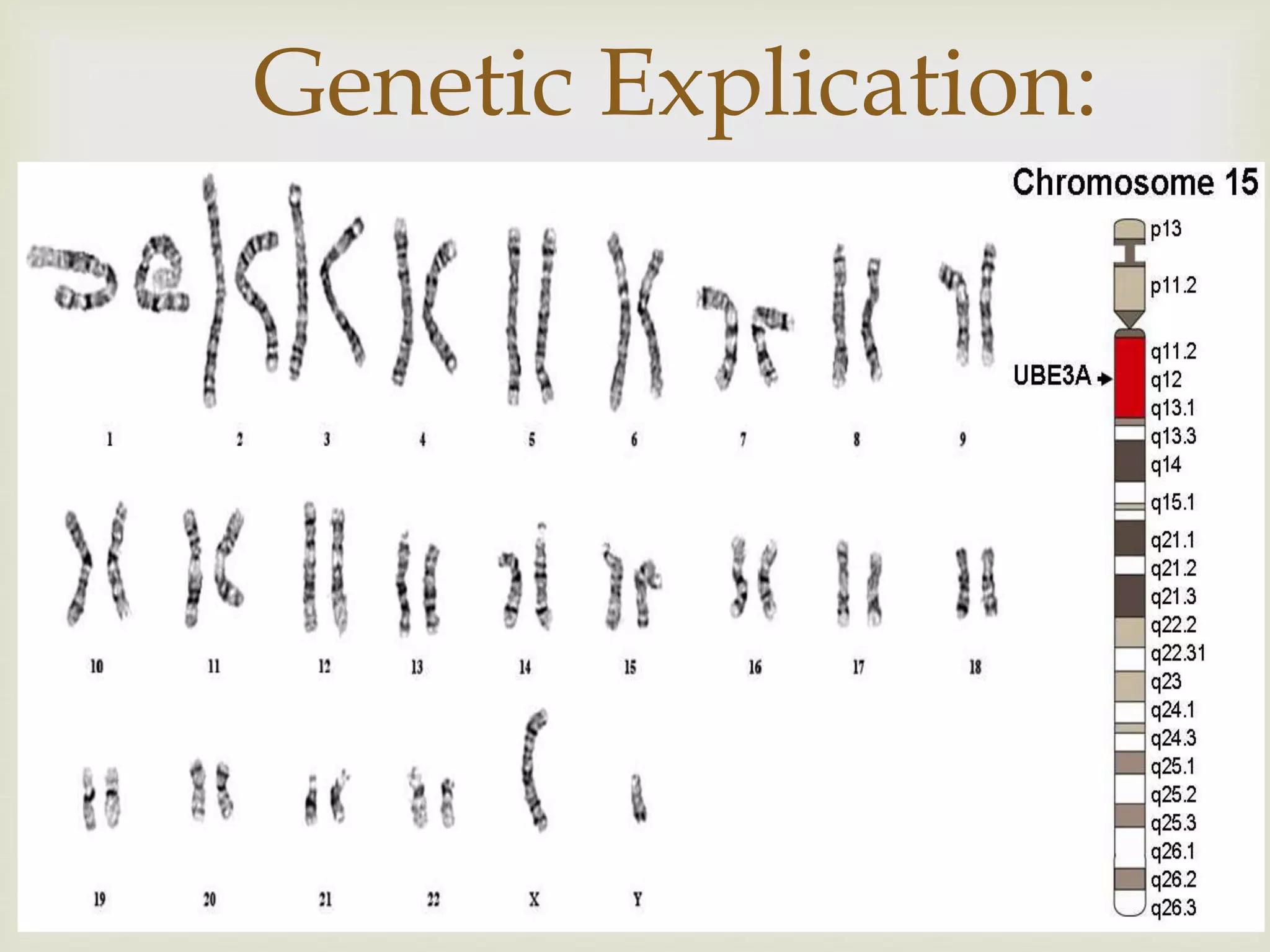 Angelman Syndrome Karyotype