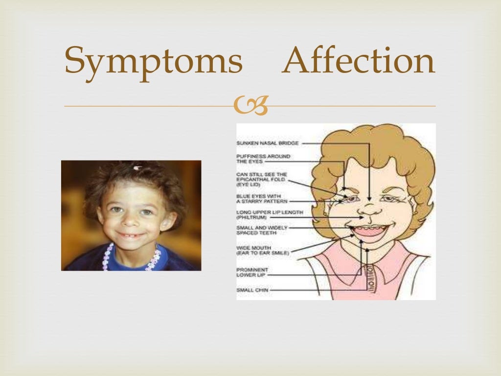 Angelman Syndrome.