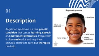 Angel Man syndrome presentation powerpoint | PPTX