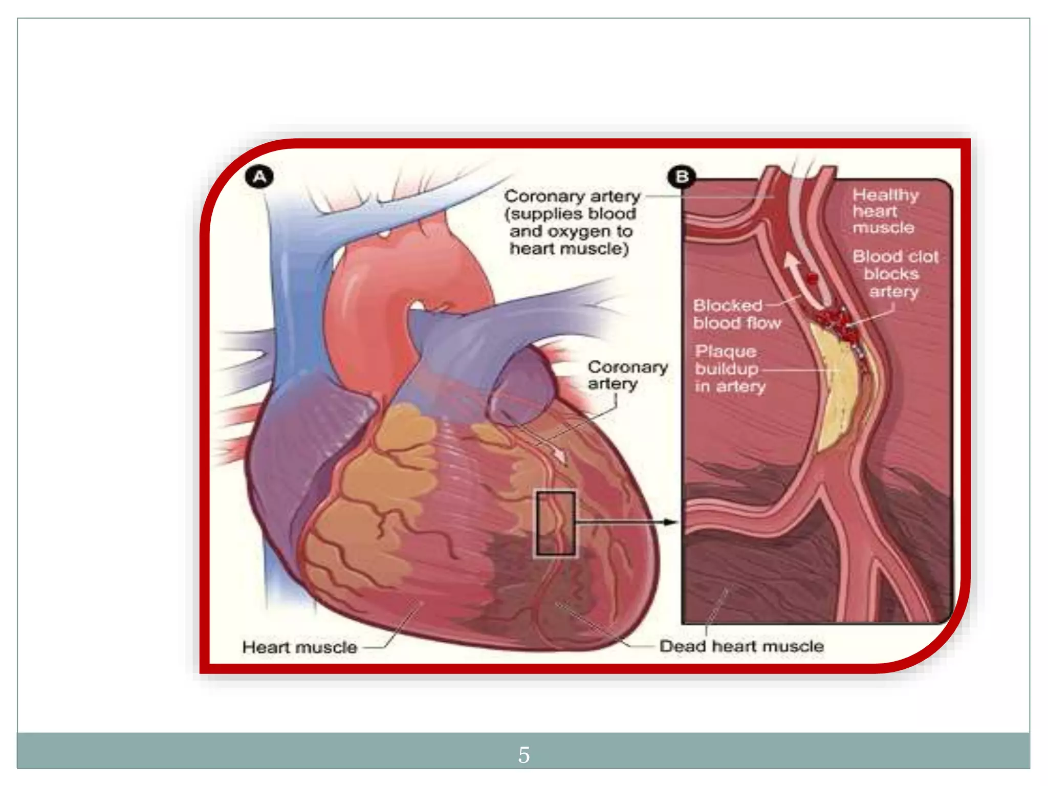 Angina pectoris | PPT