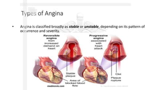 Angina ant its pharmacotherapy | PPTX