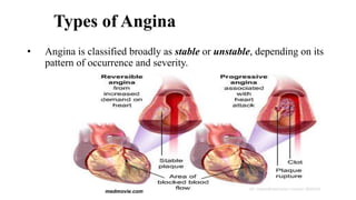 Pathophysiology of angina and atheroslerosis | PPTX