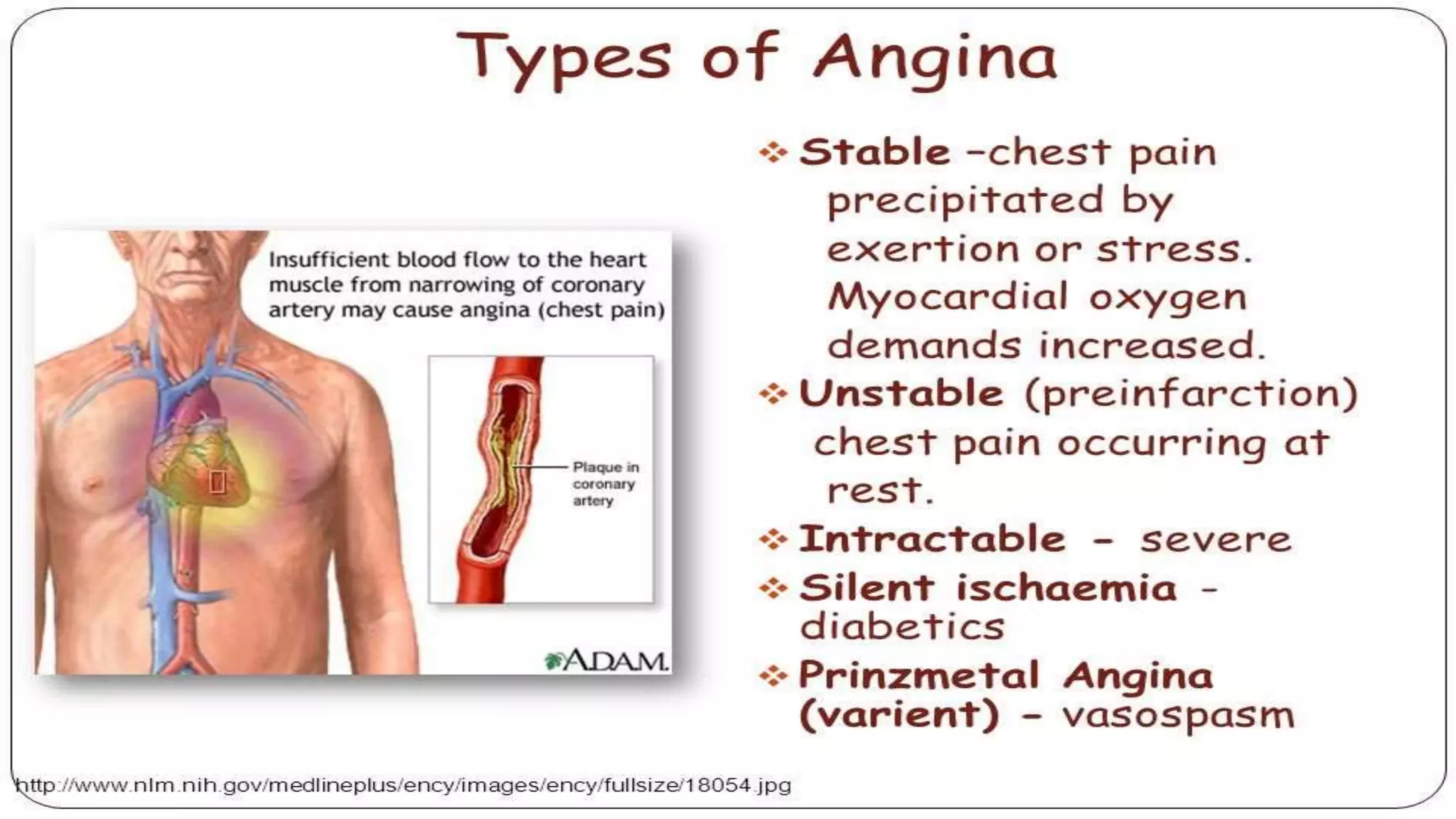 Angina | PPTX