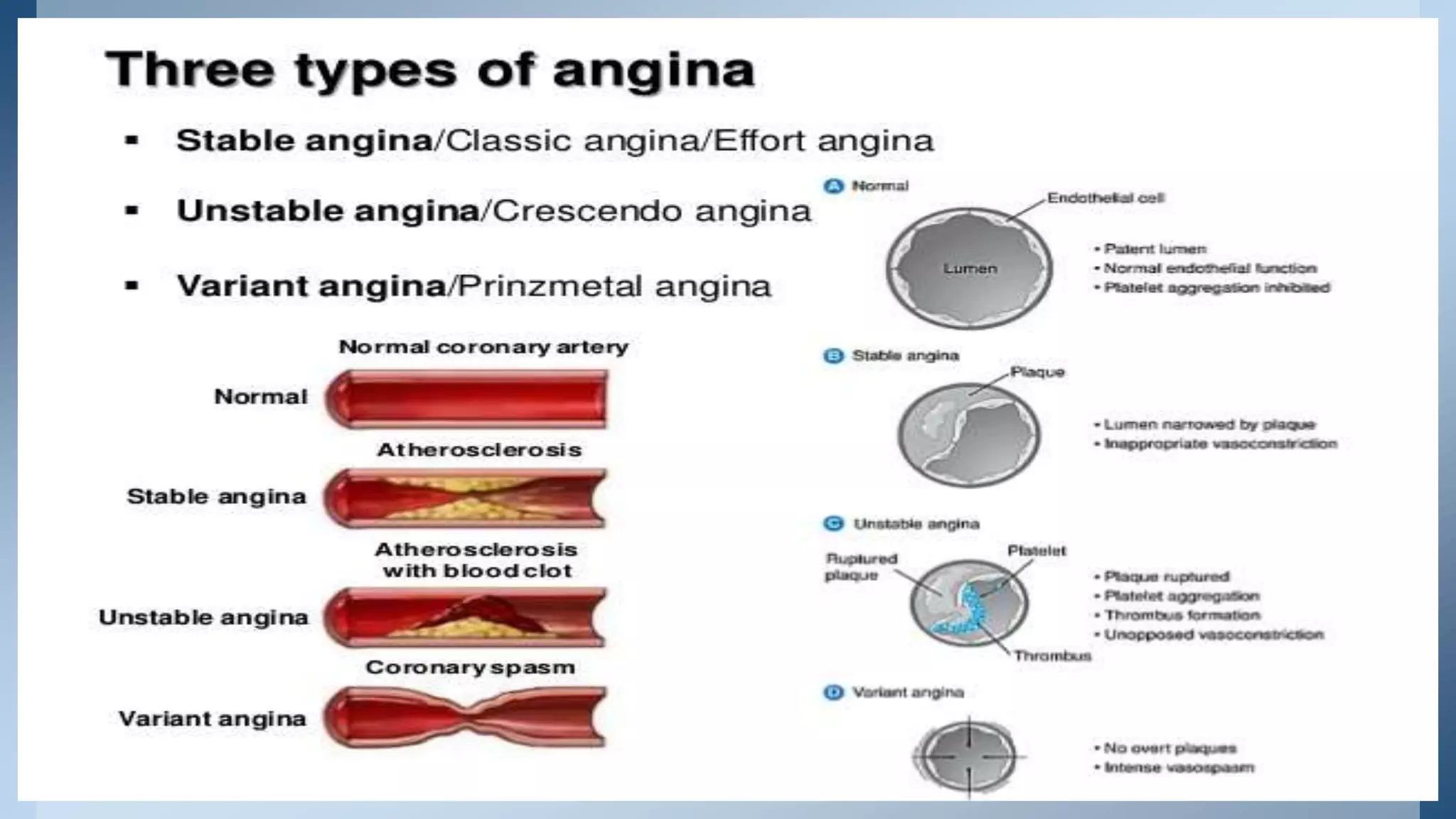 Angina | PPTX