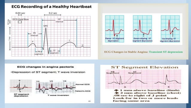 Angina | PPTX | Heart and Cardiovascular Diseases | Diseases and Conditions