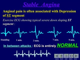 Angina | PPT