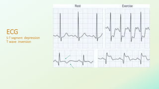 Angina | PDF