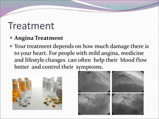 angina.ppt | Heart and Cardiovascular Diseases | Diseases and Conditions