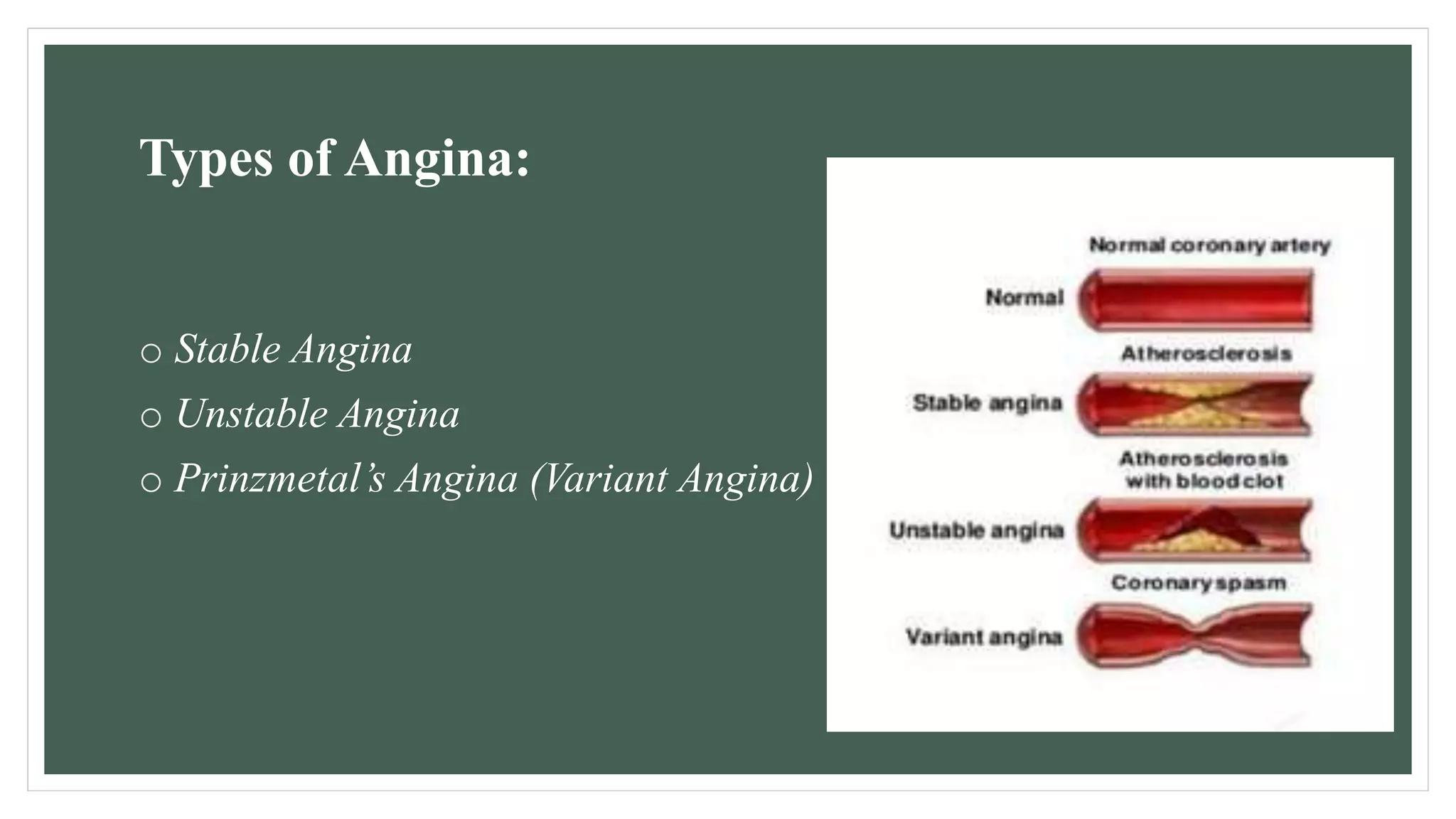 angina.pptx | Heart and Cardiovascular Diseases | Diseases and Conditions