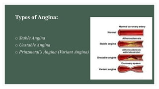 angina.pptx | Heart and Cardiovascular Diseases | Diseases and Conditions