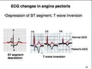 Angina.ppt