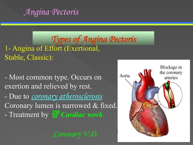 Angina for medical bds students class ppt | PPT