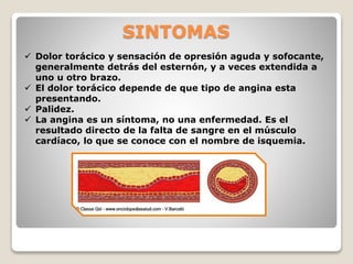 Angina de-pecho | PPTX