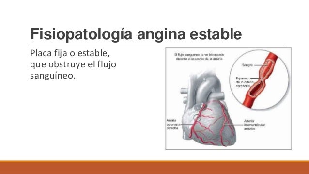 Cardiopatía isquémica: Angina estable e inestable