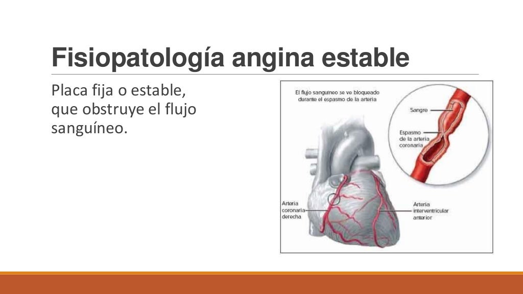 Cardiopatía isquémica: Angina estable e inestable