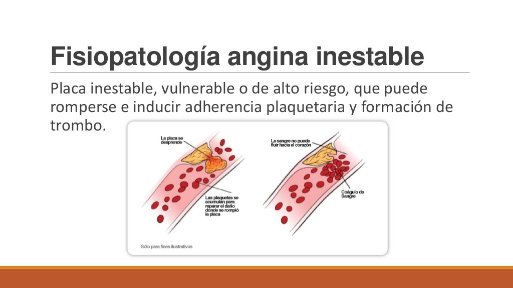 Cardiopatía isquémica: Angina estable e inestable