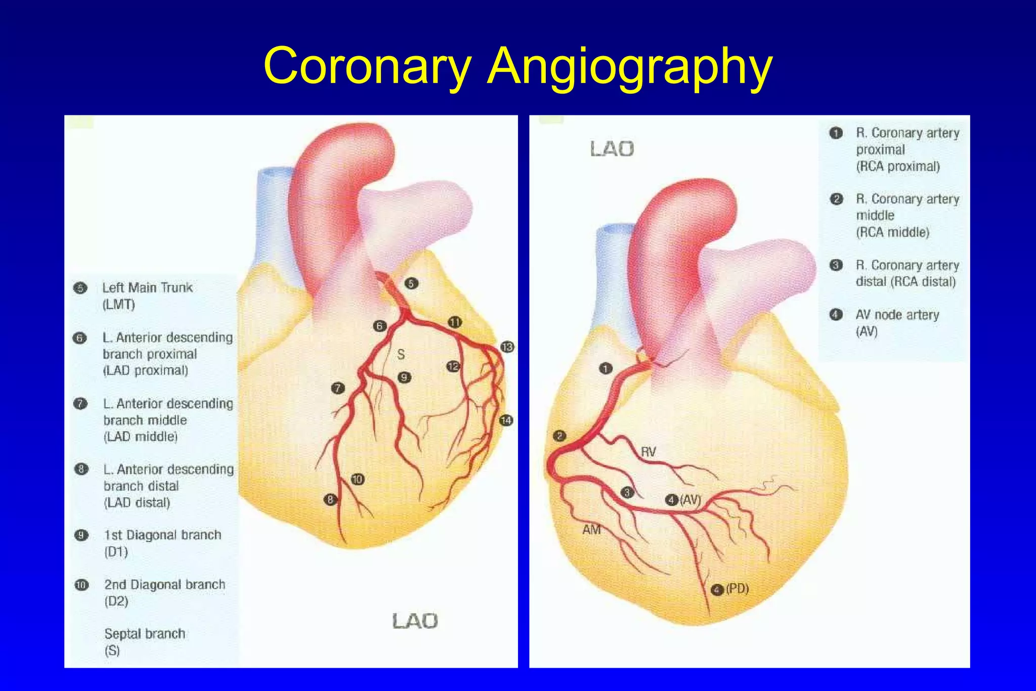 Chronic Stable Angina | PPT