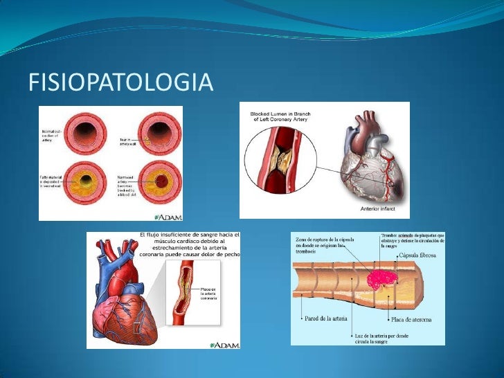 Angina de pecho y tx