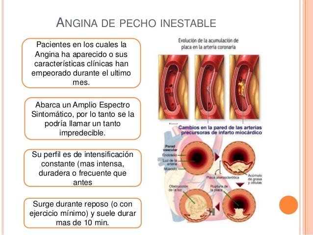 Angina de pecho