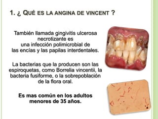 Angina de vincent - modelos unicausal y multicausal | PPTX