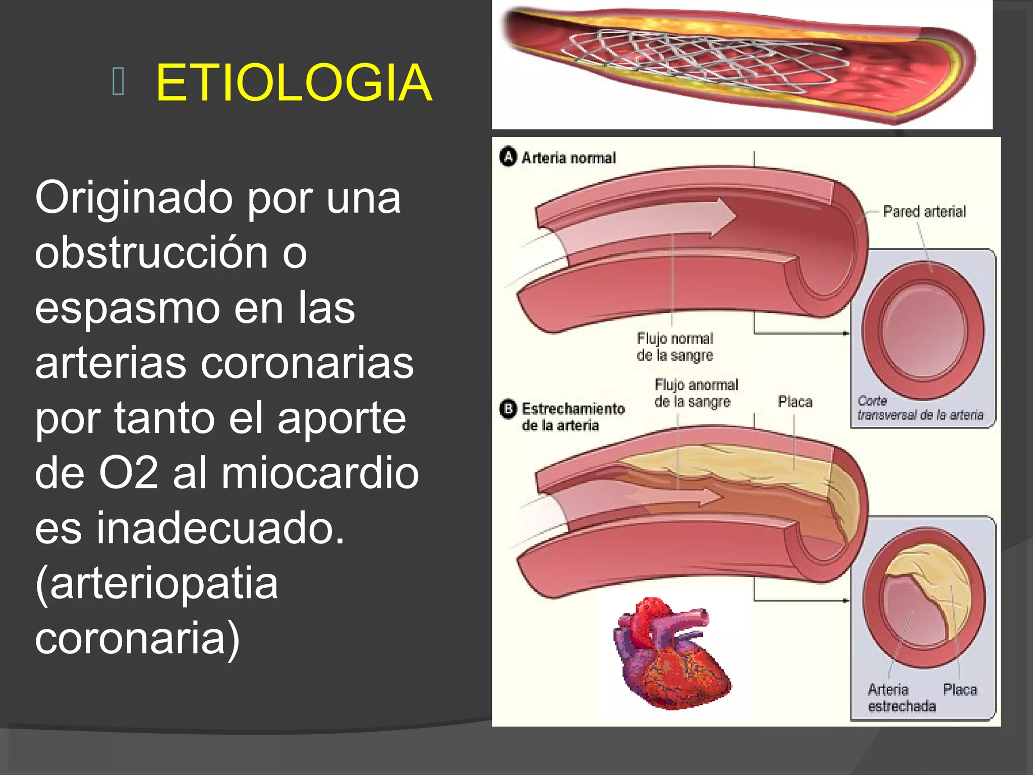 Angina inestable2 | PPT