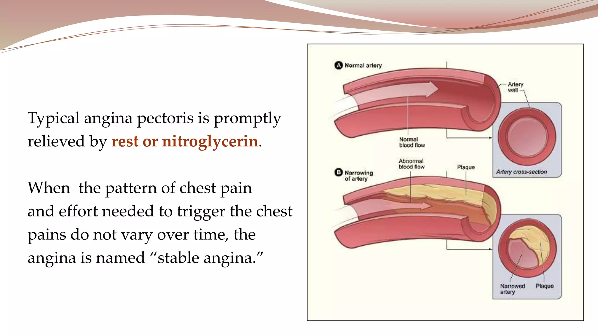 Angina pectoris | PPTX
