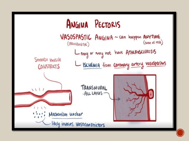 Angina pectoris | PPT