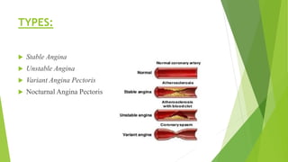 Angina Pectoris | PPTX