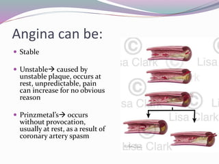 Angina pectoris | PPT