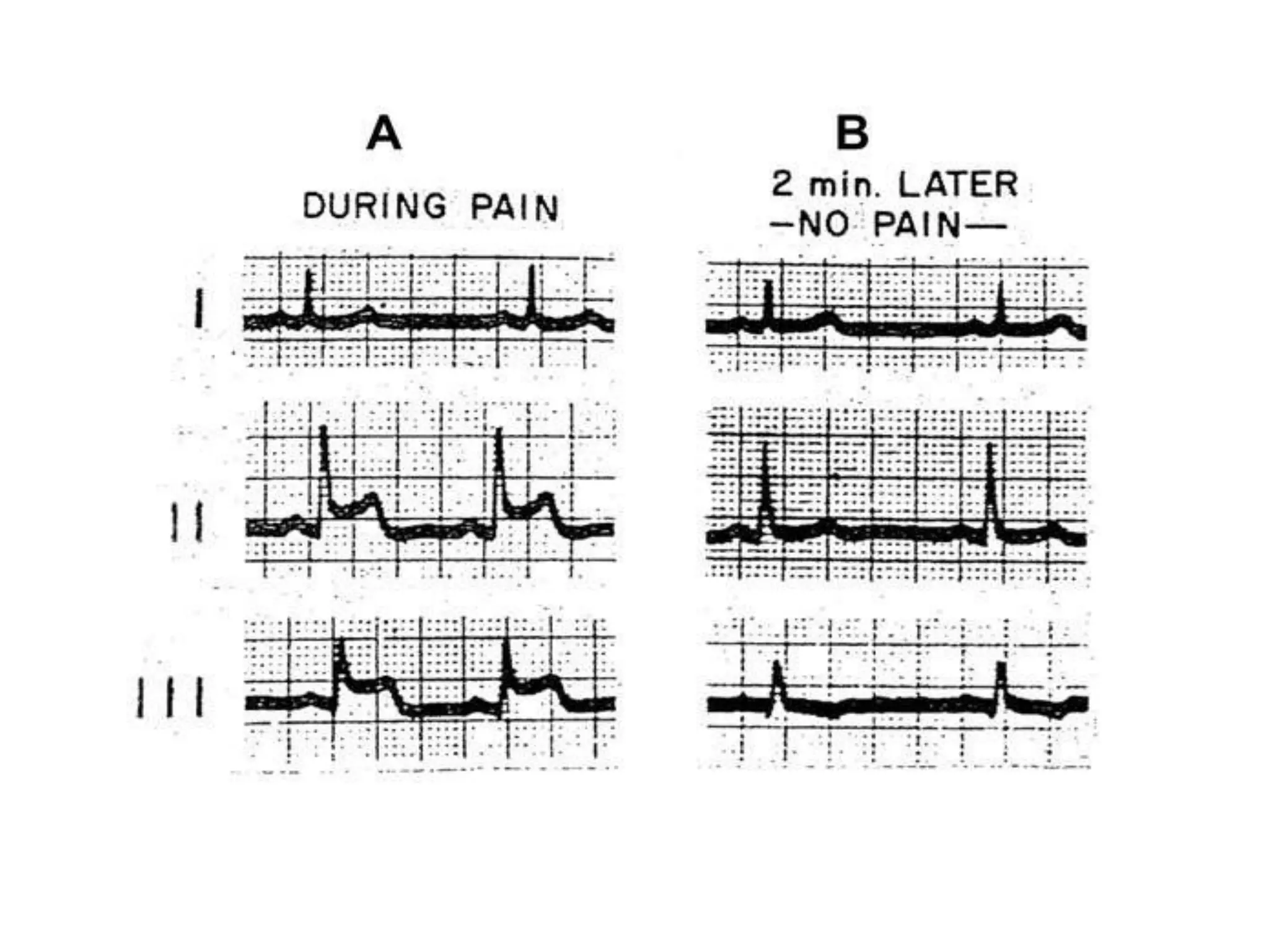 anginapectoris.pptx | Free Download