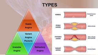 angina pectoris.pptx