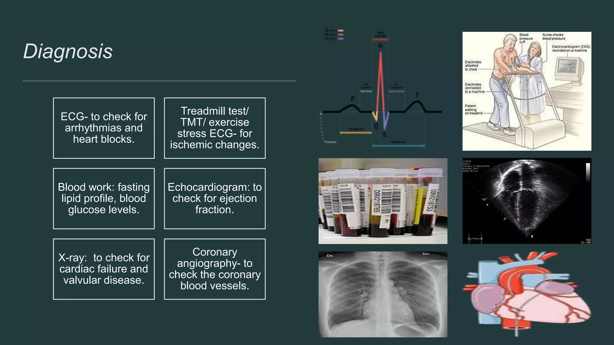 ANGINA PECTORIS | PPTX