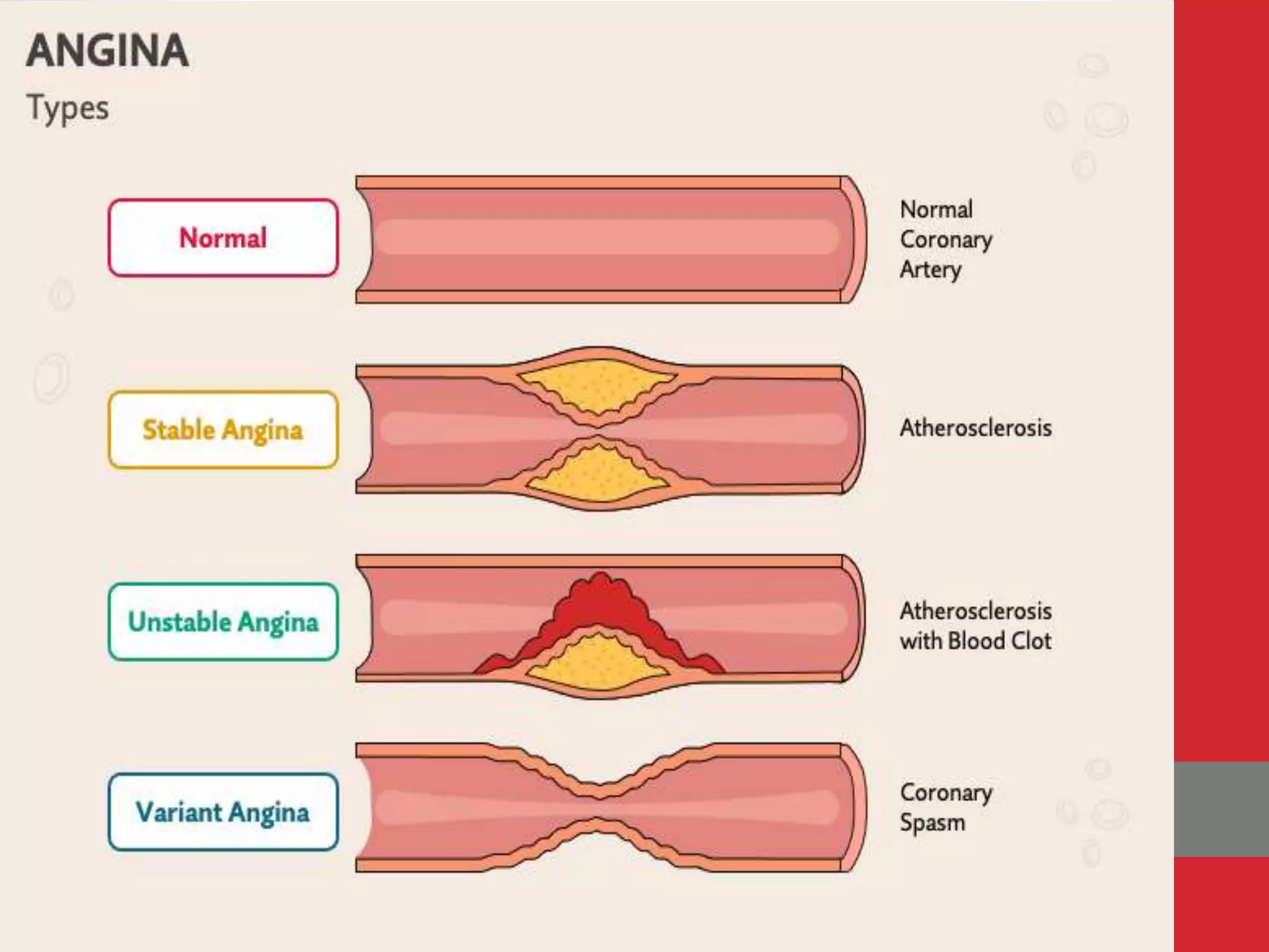 Angina Pectoris.pptx