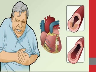 Angina Pectoris.pptx