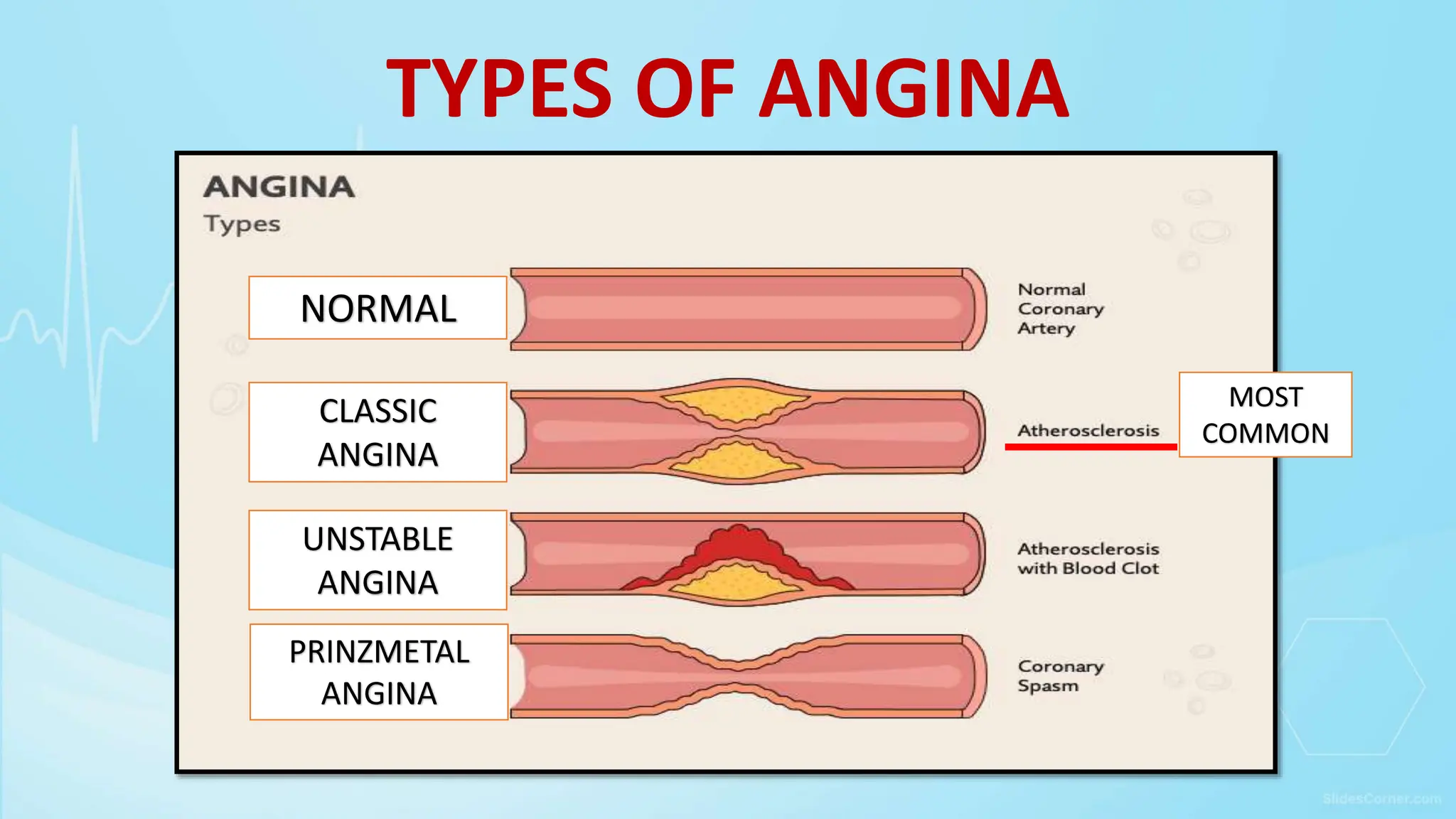 ANGINA PECTORIS.pptx