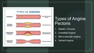 cv -2-b angina pectoris by mahesh junghare | PPT