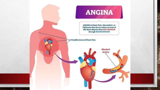 Angina Pectoris .pptx