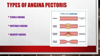 Angina Pectoris .pptx