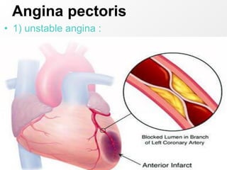 Angina pectoris by student at ahram canadian university | PPT