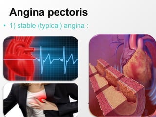 Angina pectoris by student at ahram canadian university | PPT
