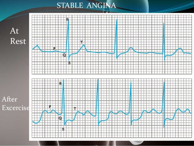 Angina pectoris
