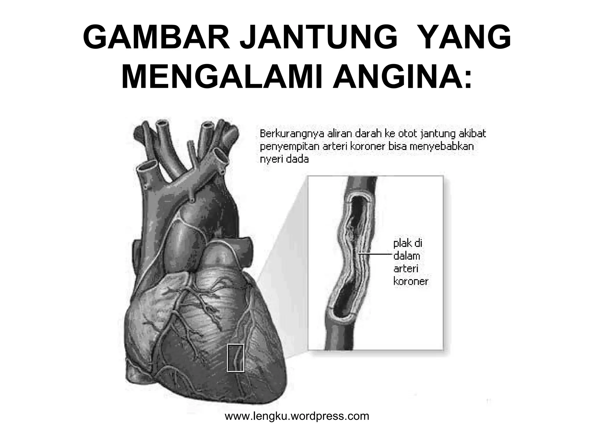 Angina pectoris preasentation | PPT