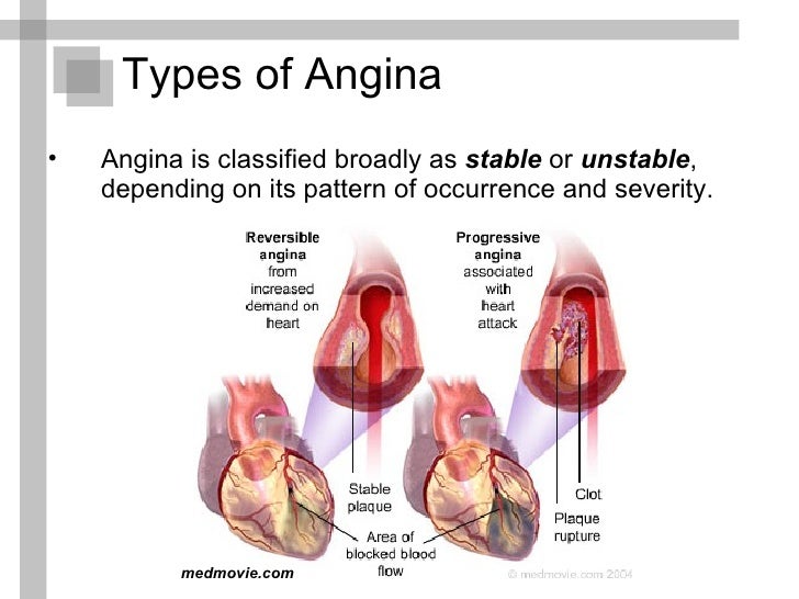 Angina pectoris presentation