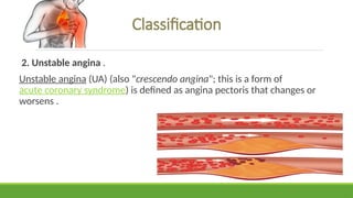 angina pectoris,seminar_16773487.30.pptx