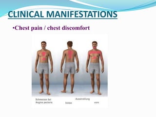 Angina pectoris | PPTX