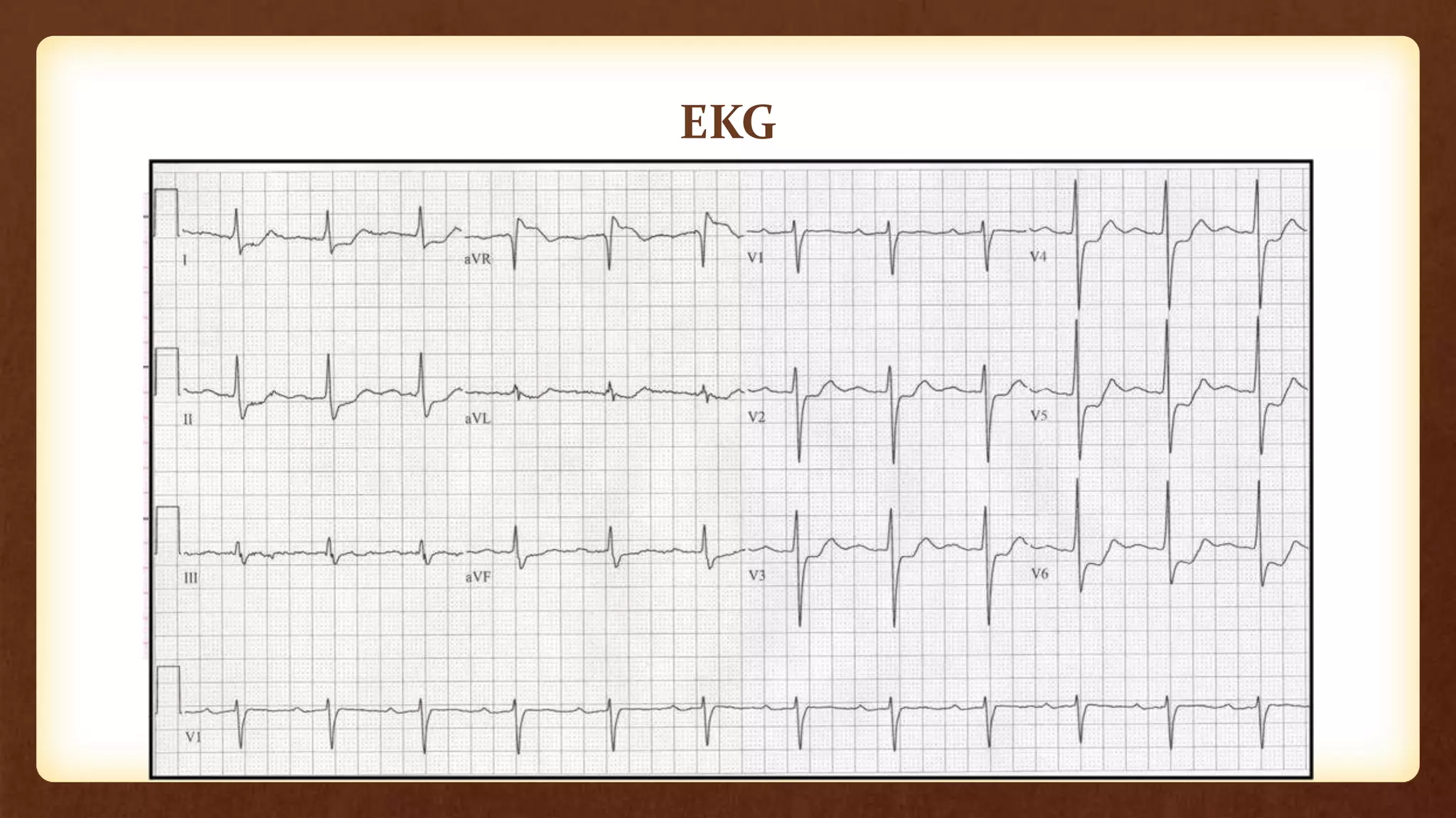 Angina pectoris stabil | PPTX
