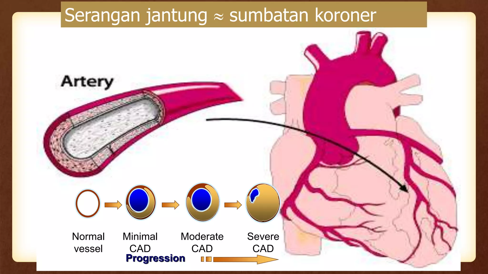 Angina pectoris stabil | PPTX