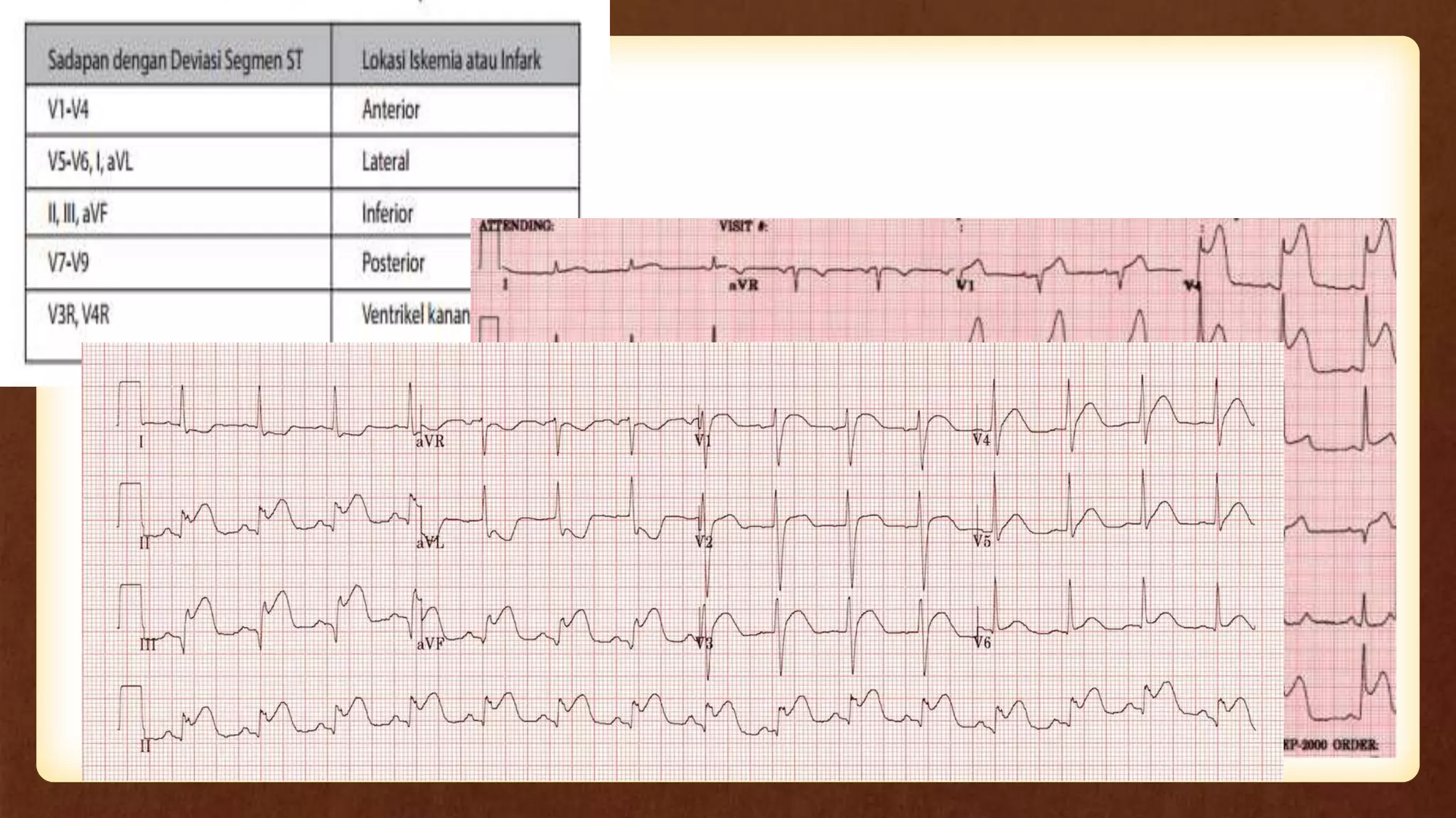 Angina pectoris stabil | PPTX