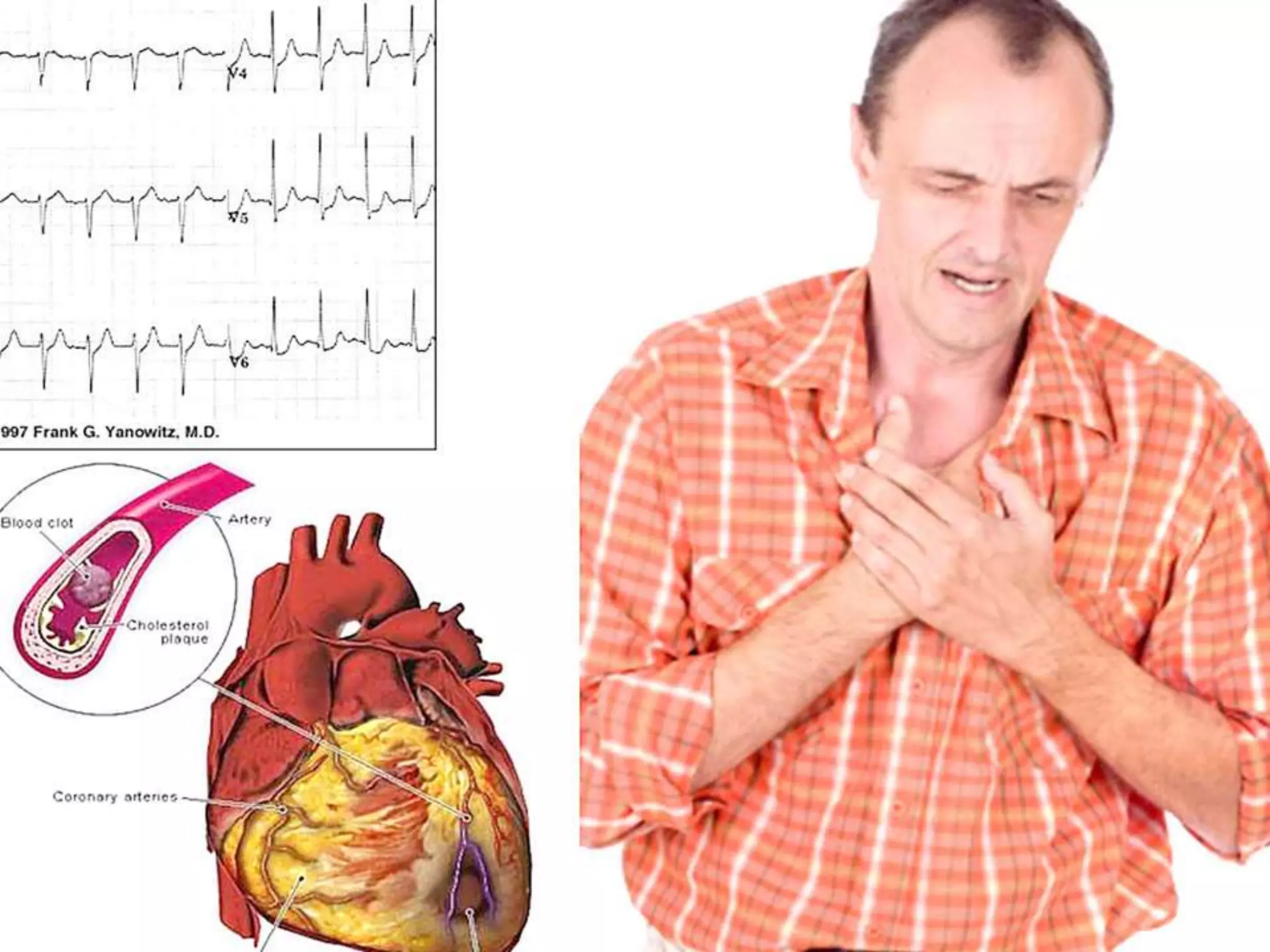 Angina Peito e Enfarte Agudo do Miocárdio | PPT